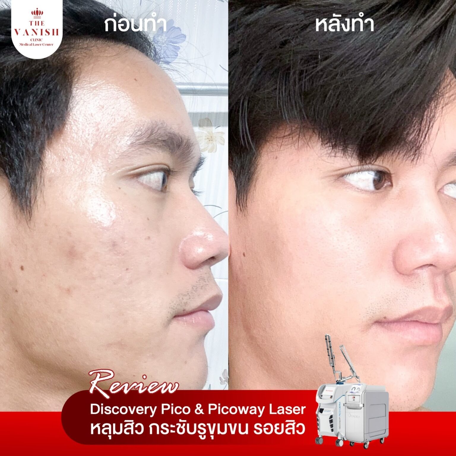 Discovery Pico Laser คืออะไร? เคลียร์จบทุกปัญหาผิวได้จริงไหม
